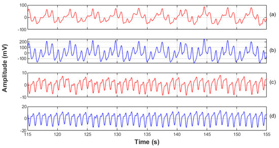 A Novel Photoplethysmography Sensor for Vital Signs Monitoring from the ...