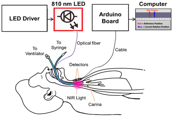 Real-Time Optical Monitoring of Endotracheal Tube Displacement