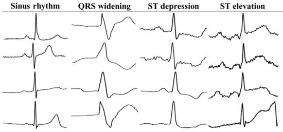 Integrating ECG Monitoring and Classification via IoT and Deep Neural Networks