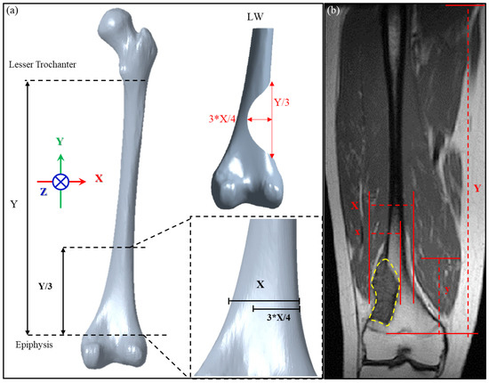 Biomechanical Analysis and Design Method for Patient-Specific ...