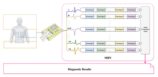 EvoMBN: Evolving Multi-Branch Networks on Myocardial Infarction ...
