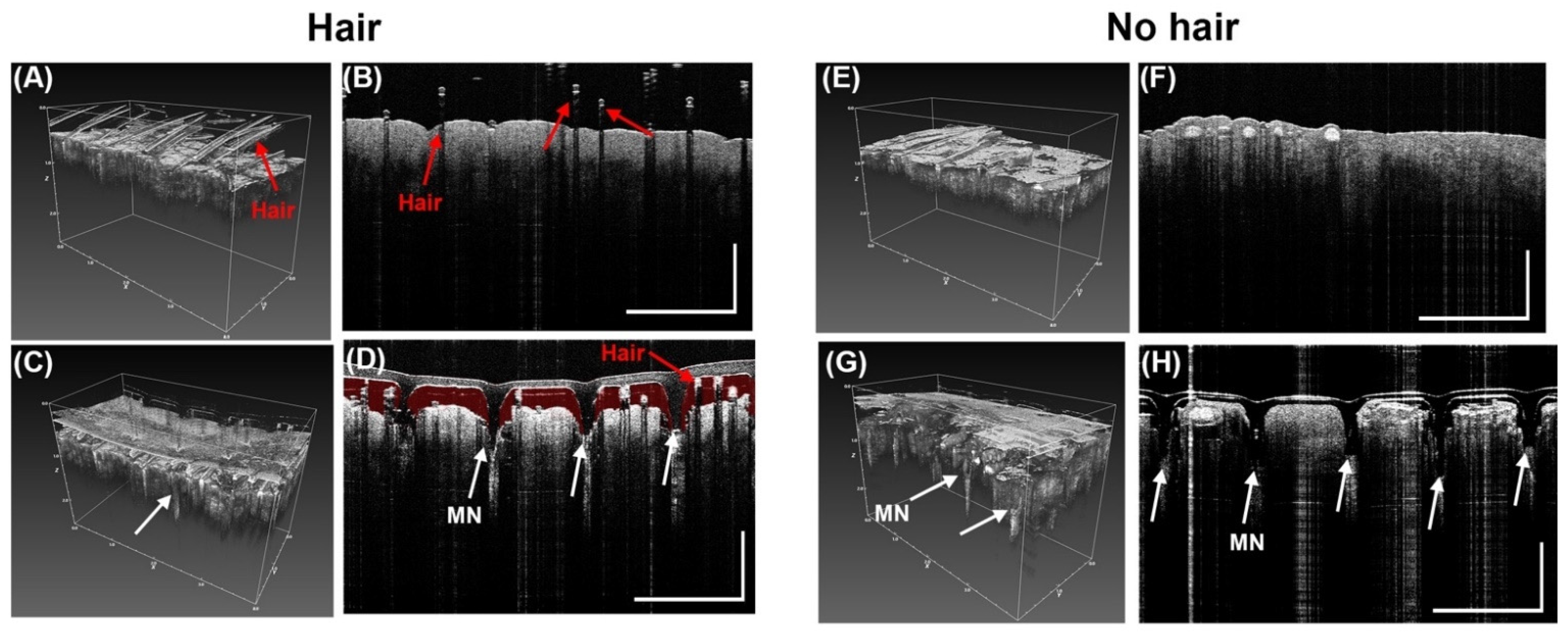 Direct Capture and Early Detection of Lyme Disease Spirochete in Skin ...