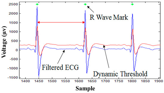 Vital Signs Sensing Gown Employing ECG-Based Intelligent Algorithms