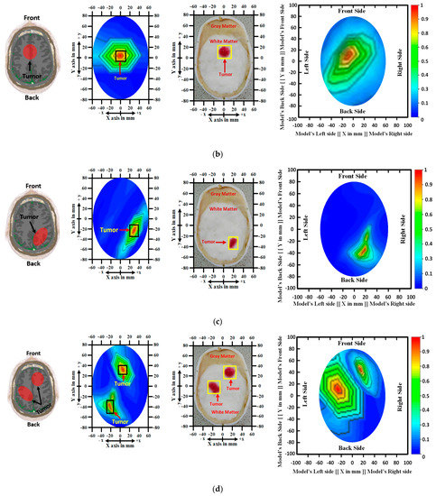 Brain Tumor Segmentation and Classification from Sensor-Based Portable ...