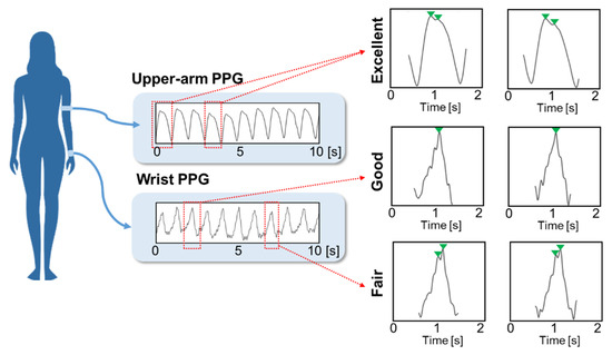 Biosensors | Free Full-Text | Upper-Arm Photoplethysmographic Sensor ...