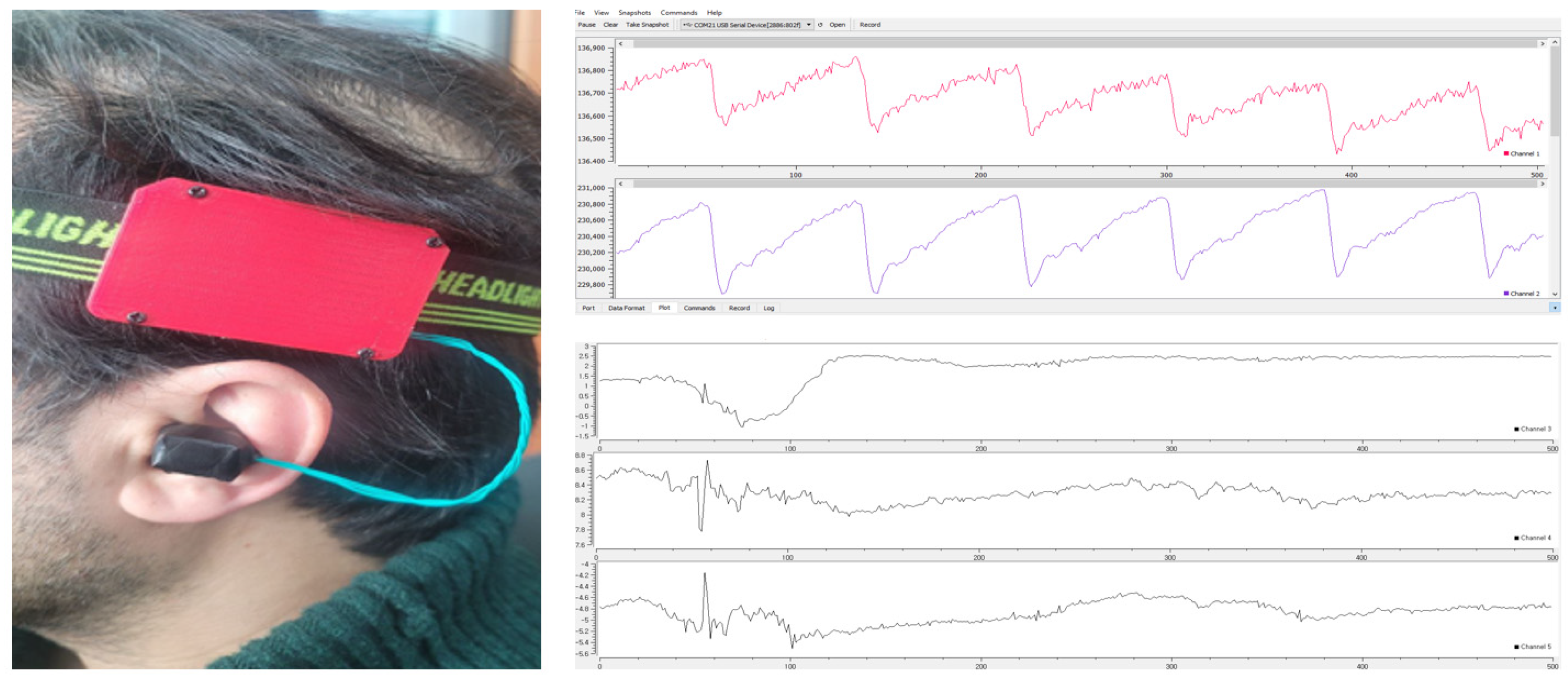 Mental Stress Detection Using a Wearable In-Ear Plethysmography