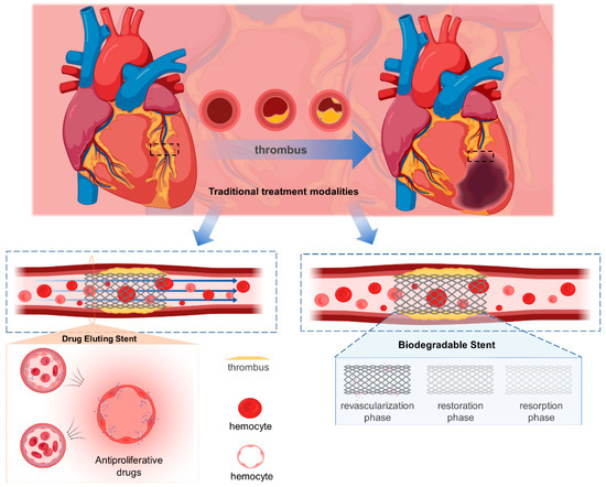 Liquid Metal-Based Flexible Bioelectrodes for Management of In-Stent ...