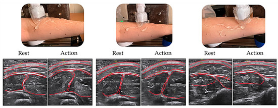An Approach to Using Electrical Impedance Myography Signal Sensors to ...