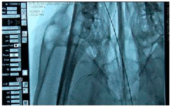 Development of a Brain Catheter for Optical Coherence Tomography in ...