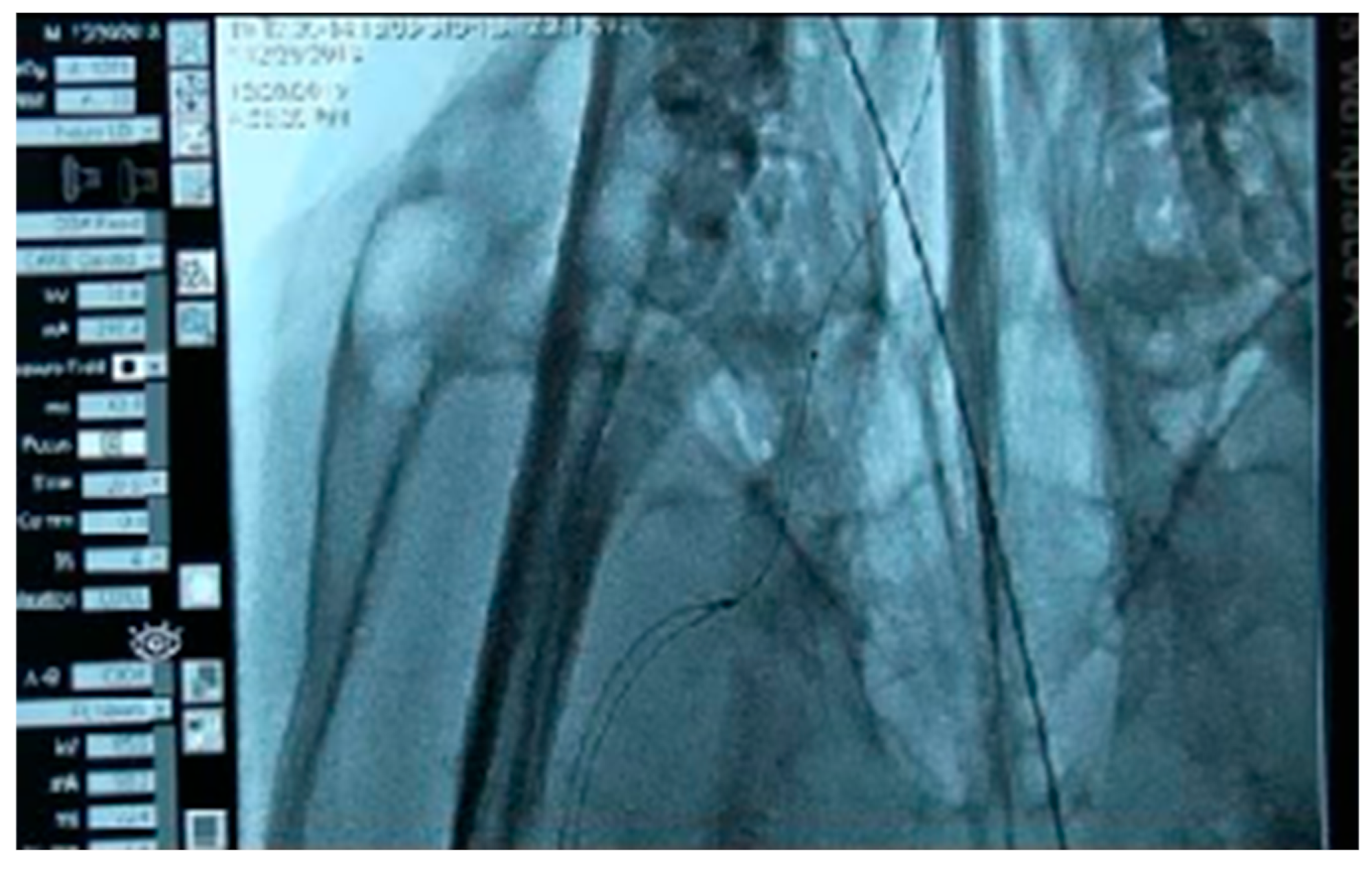 Development of a Brain Catheter for Optical Coherence Tomography in ...
