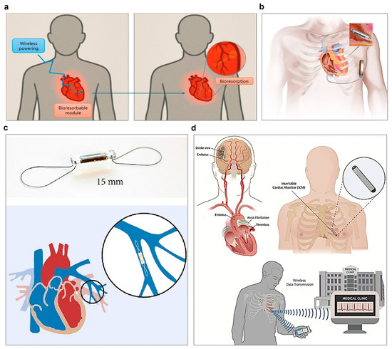 Technological Advances and Medical Applications of Implantable ...