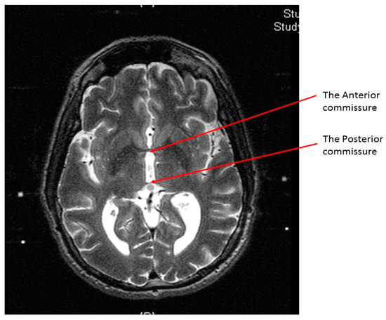 Anterior Commissure Mri