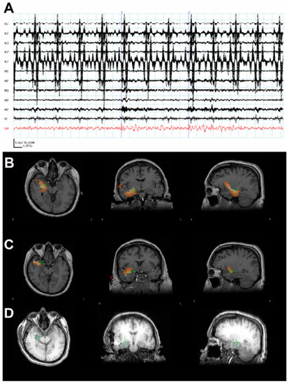 Brain Sciences | Free Full-Text | Magnetoencephalography: Clinical and ...