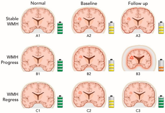 White Matter Hyperintensity Regression: Comparison of Brain Atrophy and ...