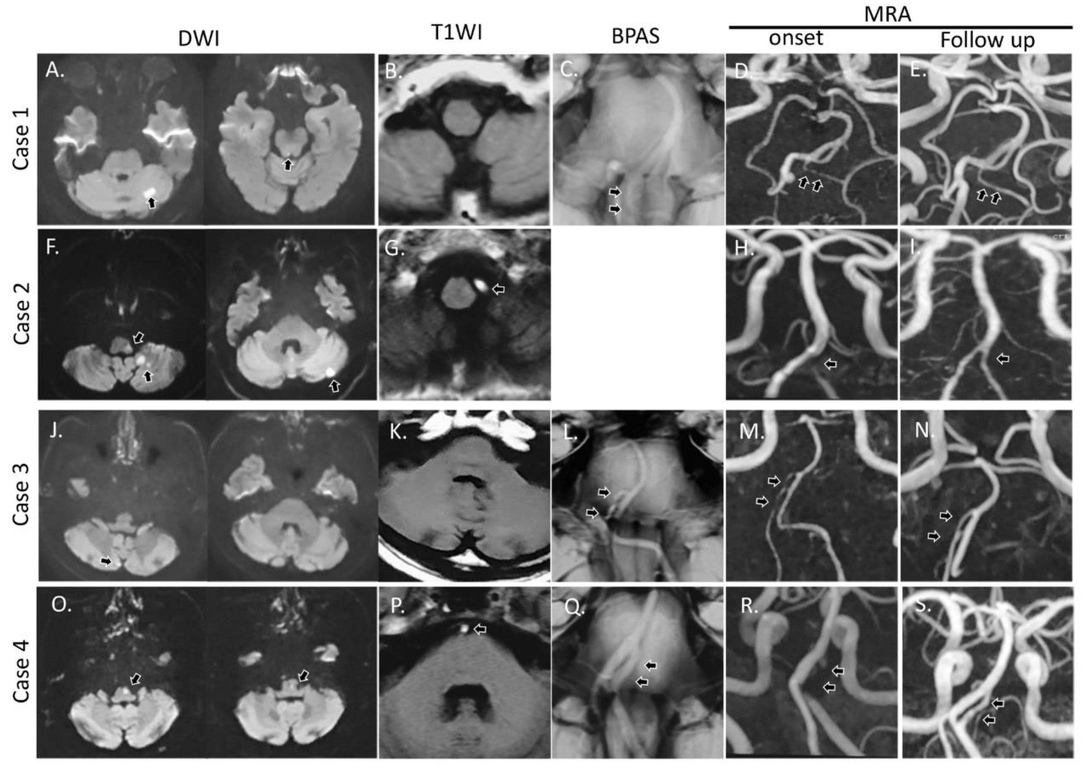 Characteristics of Clinical Symptoms, Cerebral Images and Stroke ...