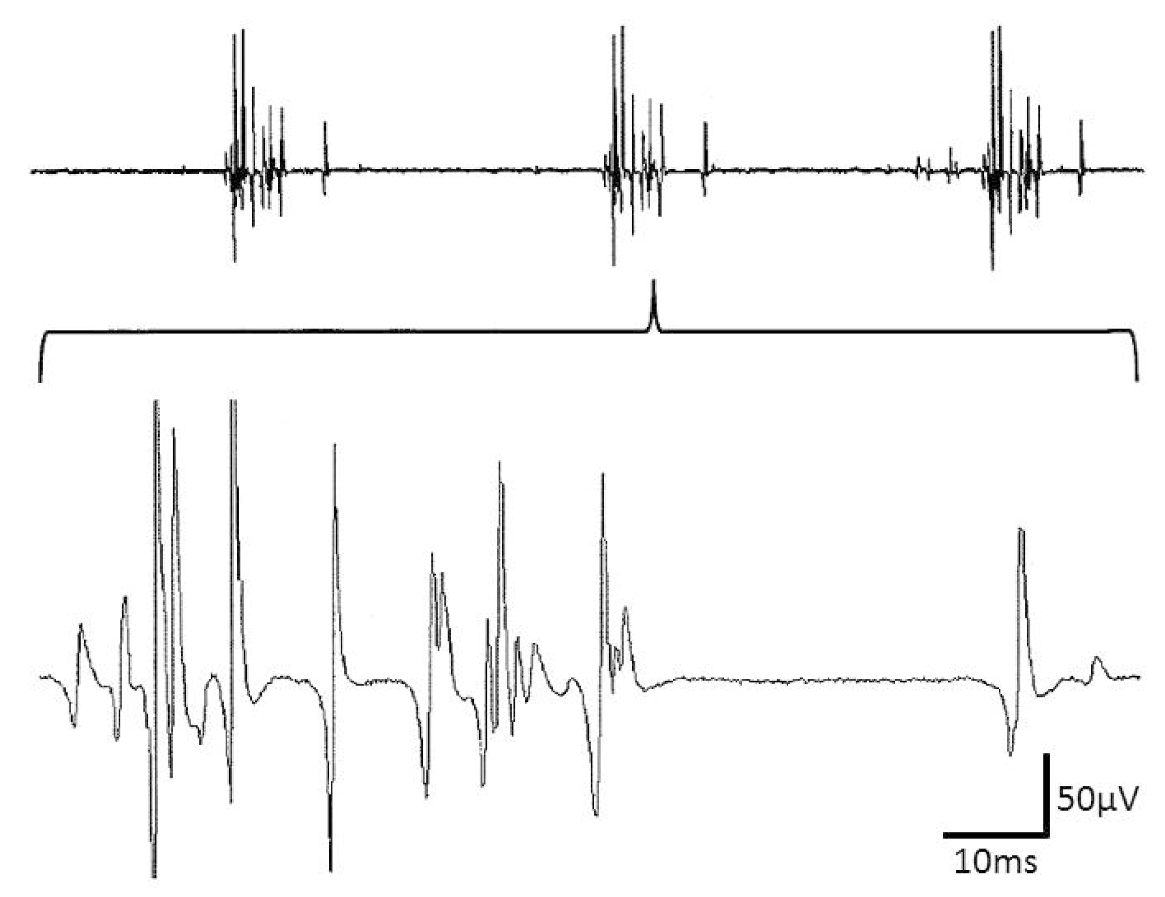 Complex Repetitive Discharges: A Sign of Motor Axonal Reinnervation?