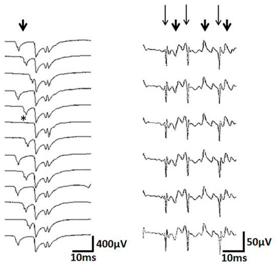 Complex Repetitive Discharges: A Sign of Motor Axonal Reinnervation?