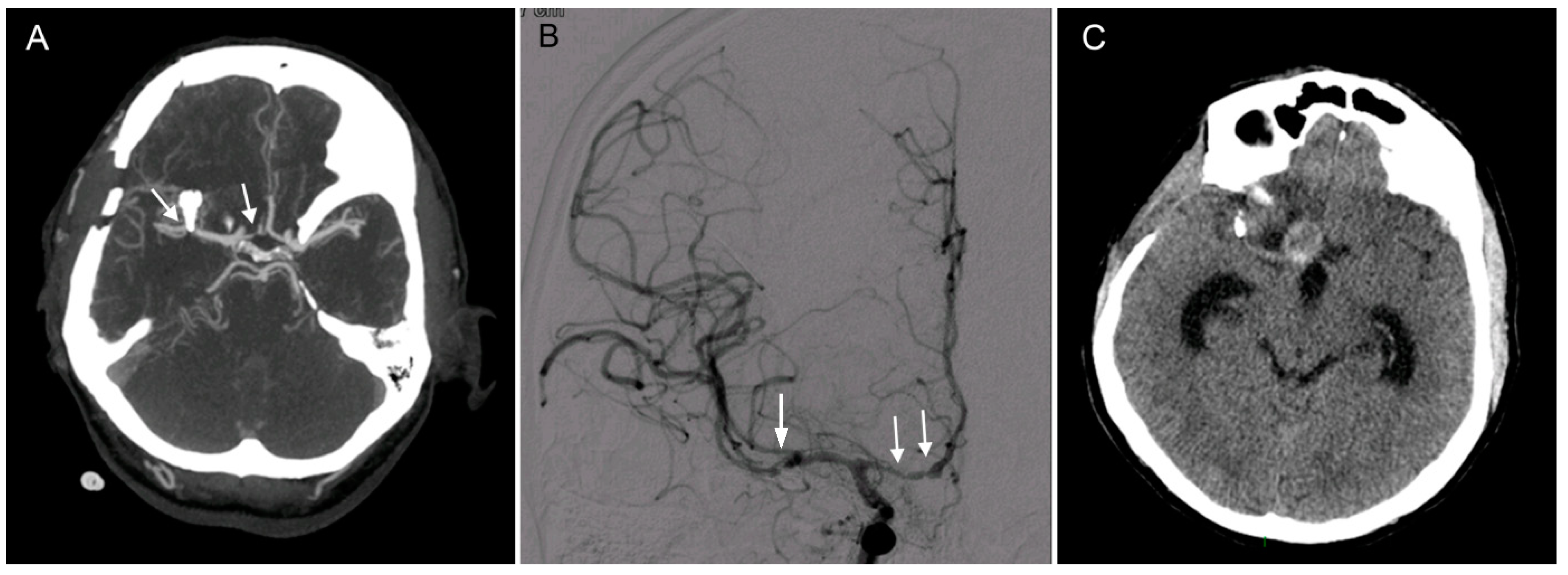 Middle Cerebral Artery Angiogram