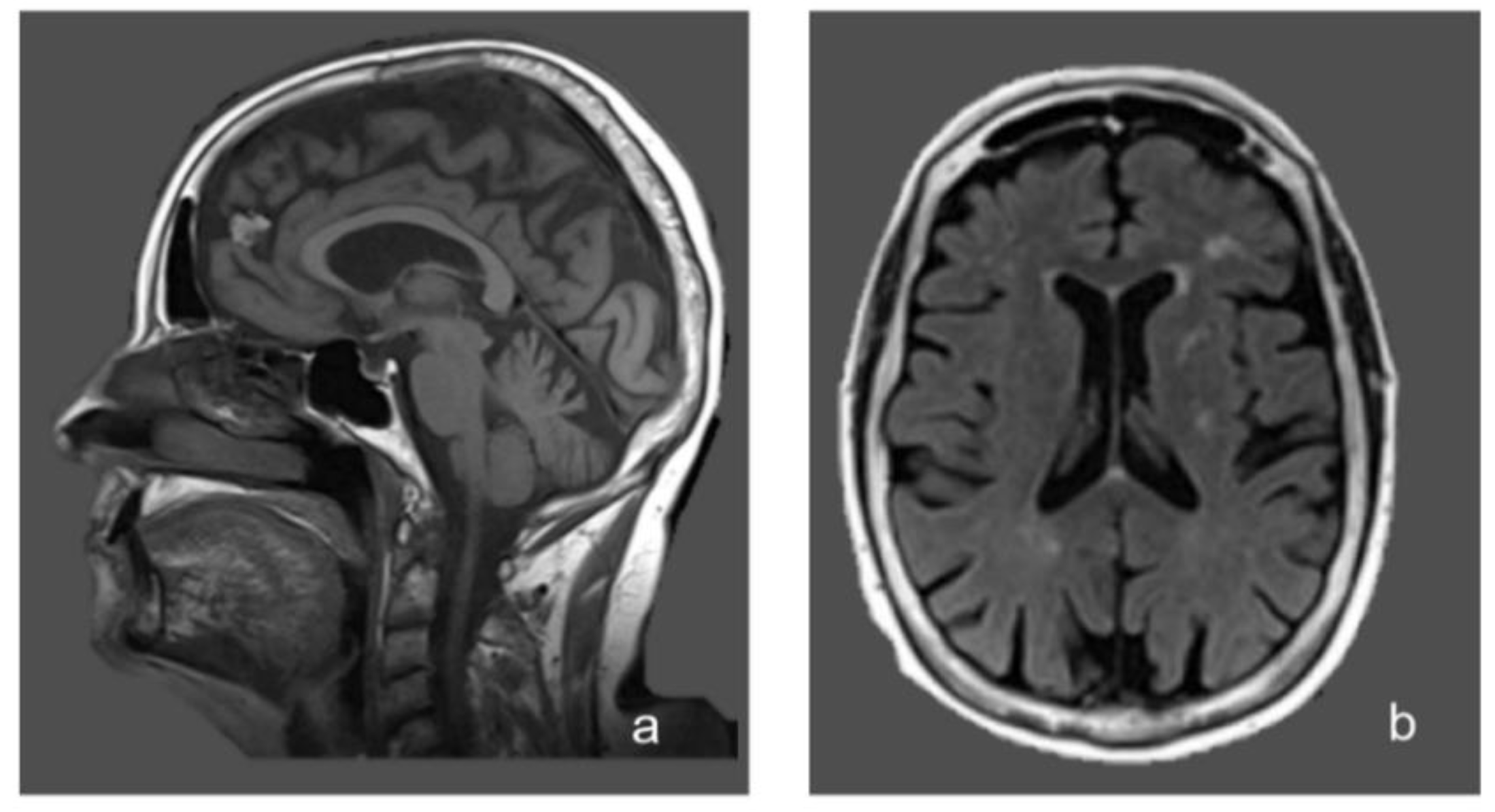 Celiac Disease Diagnosed in an Older Adult Patient with a Complex ...
