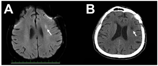 Brain Sciences Special Issue Neurosurgery For Cerebral Aneurysms