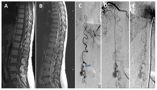 Ruptured Thoracolumbar Perimedullary Arteriovenous Fistula during ...