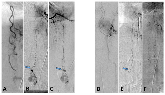 Ruptured Thoracolumbar Perimedullary Arteriovenous Fistula during ...