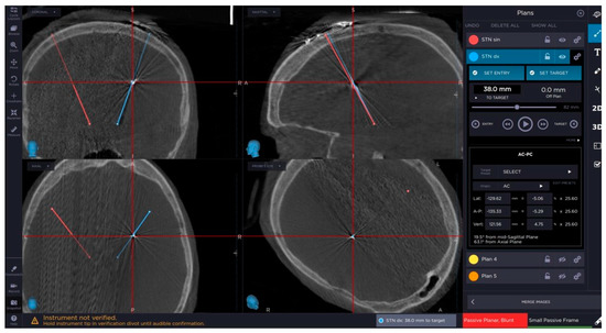 O-Arm Navigated Frameless and Fiducial-Less Deep Brain Stimulation