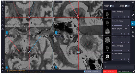 O-Arm Navigated Frameless and Fiducial-Less Deep Brain Stimulation