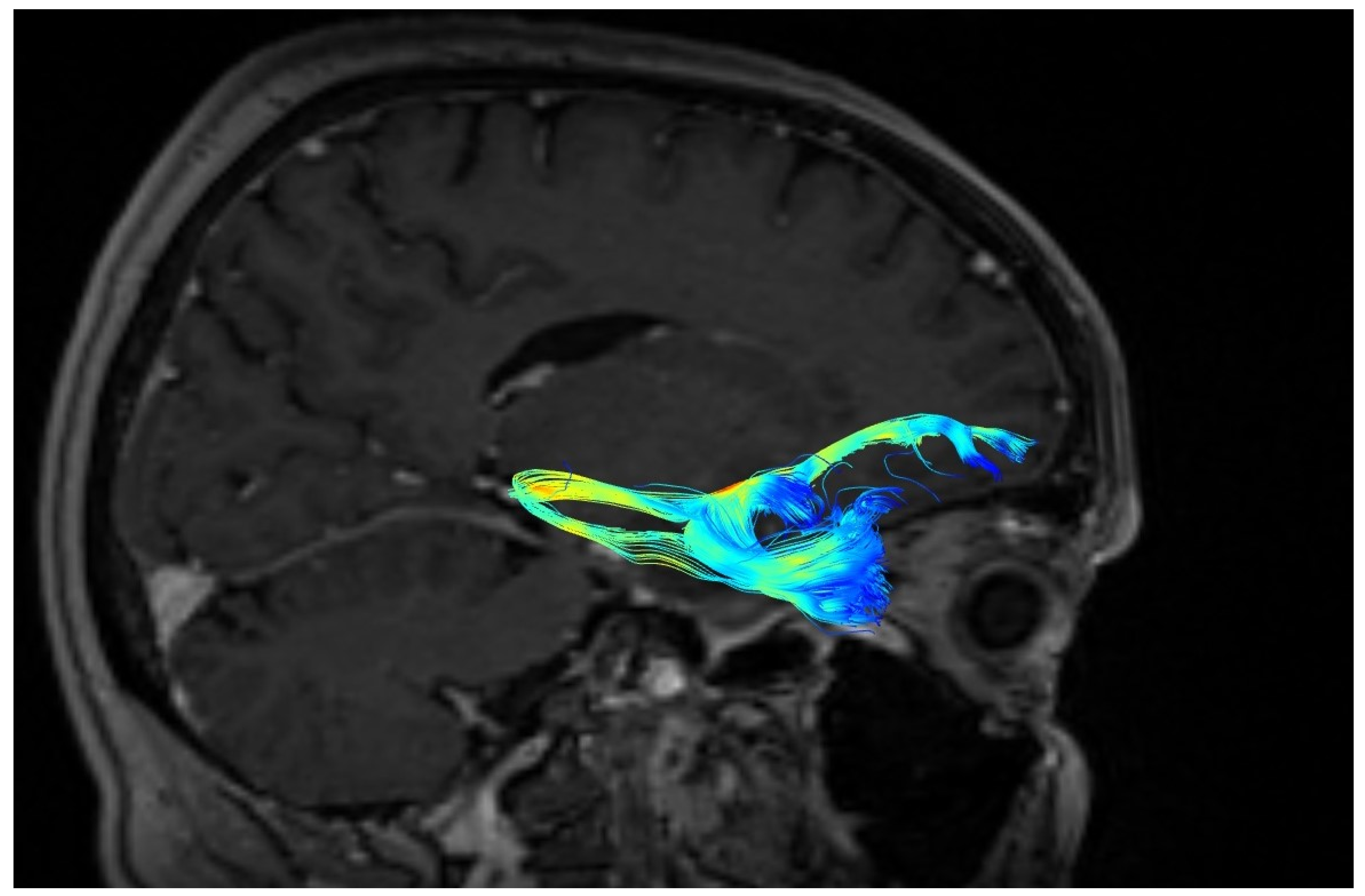 Tractography-Based Analysis of Morphological and Anatomical ...