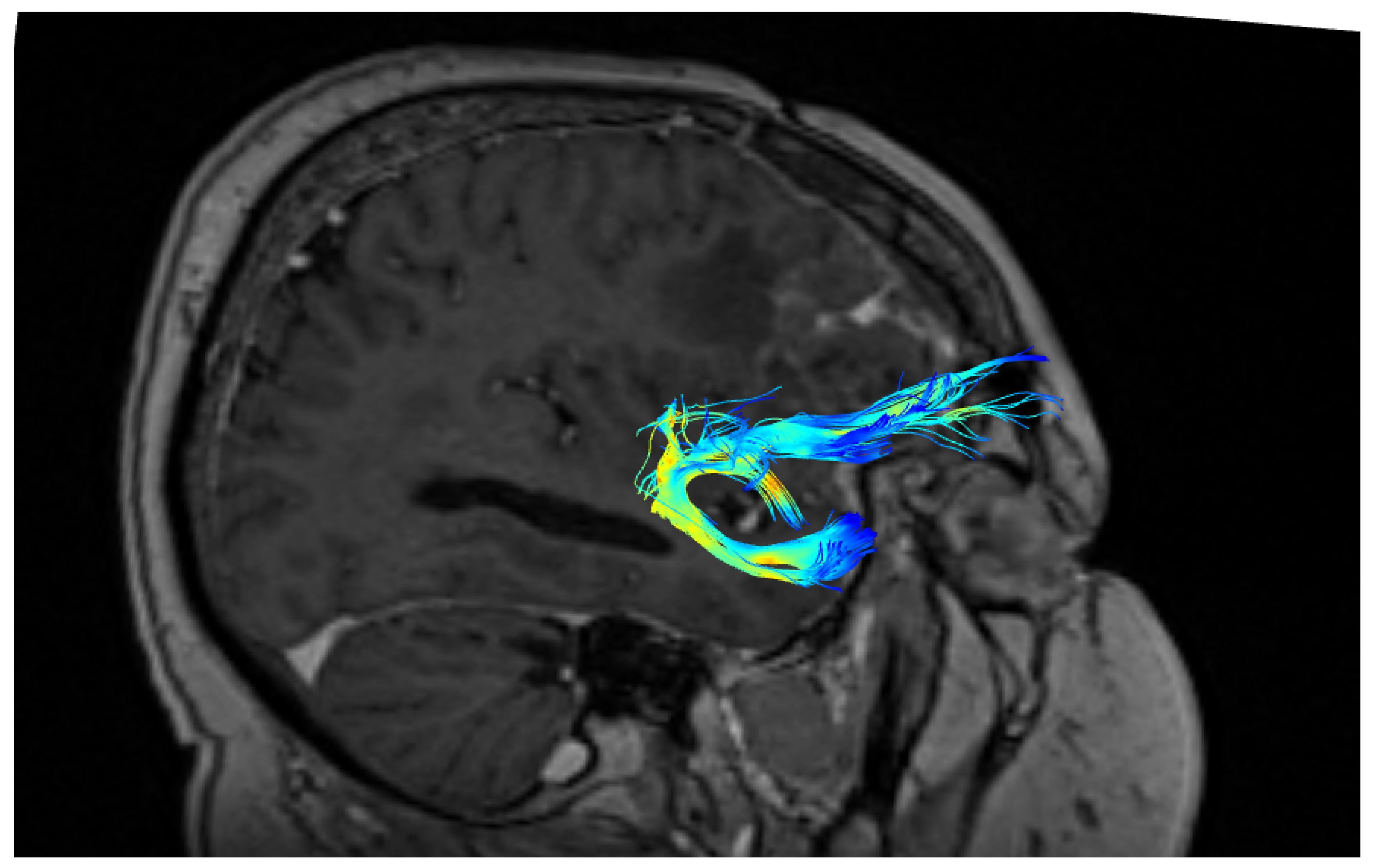 Tractography-Based Analysis of Morphological and Anatomical ...