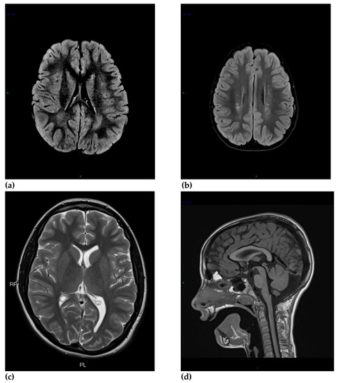 Brain Magnetic Resonance Findings in 117 Children with Autism Spectrum ...