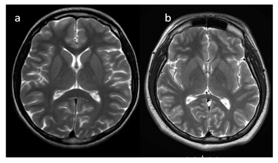 Wilsons Disease Mri