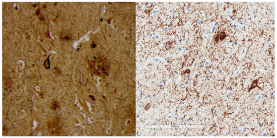 The Significance of Tau Aggregates in the Human Brain
