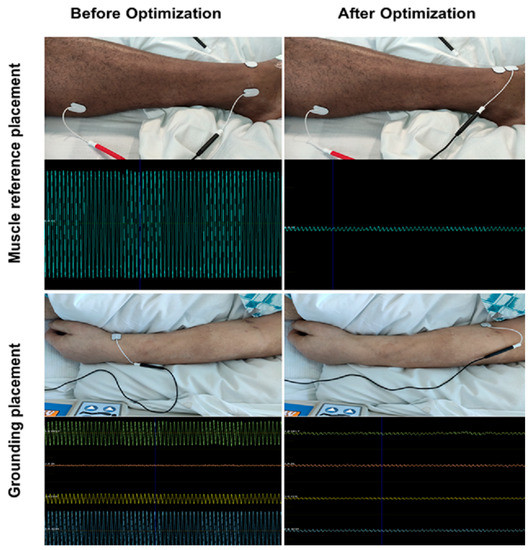 Brain Sciences | Free Full-Text | Navigated TMS in the ICU: Introducing ...