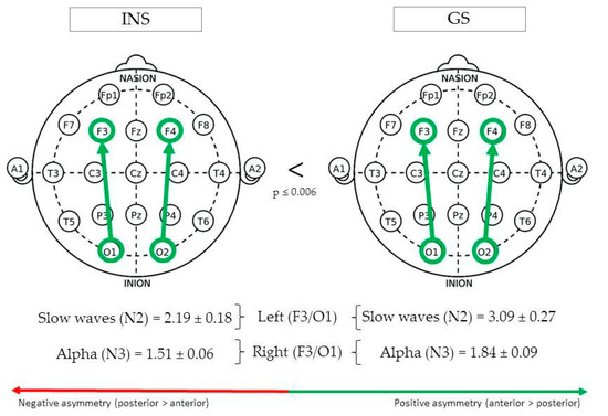 Patterns of Intrahemispheric EEG Asymmetry in Insomnia Sufferers: An ...