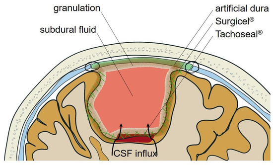Spontaneous Resolution of Late-Onset, Symptomatic Fluid Collection ...