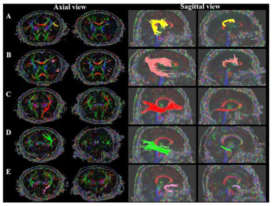 Prediction of Aphasia Severity in Patients with Stroke Using Diffusion ...
