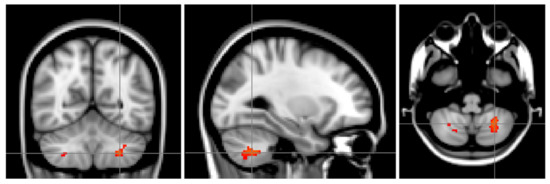 Structural Changes on MRI Demonstrate Specific Cerebellar Involvement ...