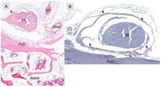 Microsurgical Anatomy of the Inferomedial Paraclival Triangle: Contents ...