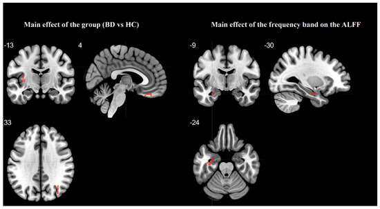 Bipolar Brain Scan Bipolar Disorders In Teenagers