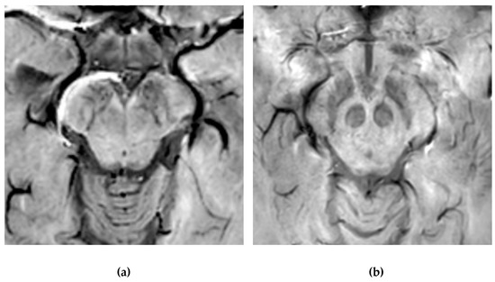 Imaging of Substantia Nigra in Parkinson’s Disease: A Narrative Review