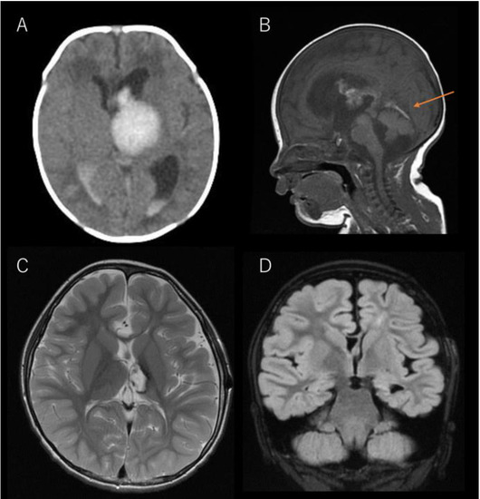 Brain Sciences | Special Issue : Corpus Callosotomy
