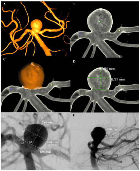 Optimal Woven EndoBridge (WEB) Device Size Selection Using Automated ...