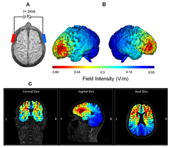 Effects of tDCS on Language Recovery in Post-Stroke Aphasia: A Pilot ...