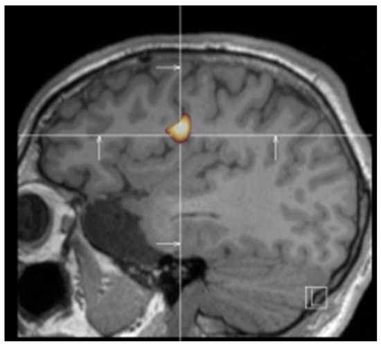 Epilepsy and Ecstatic Experiences: The Role of the Insula