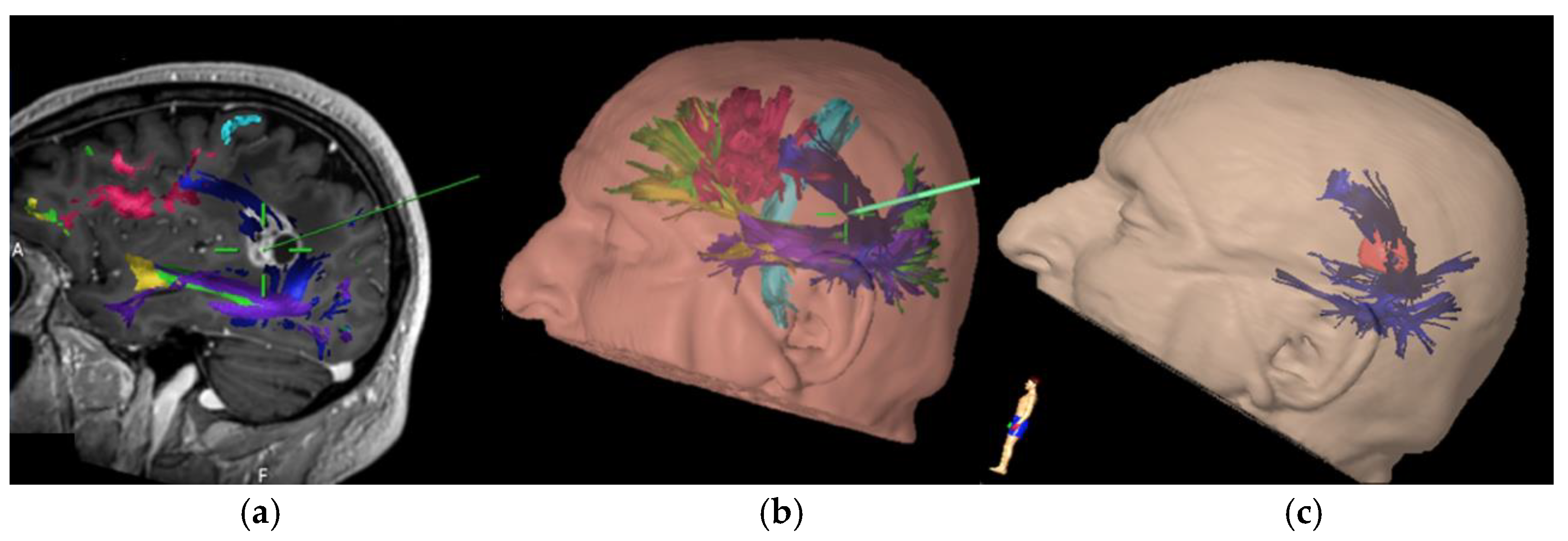 The Relevant Role of Navigated Tractography in Speech Eloquent Area ...