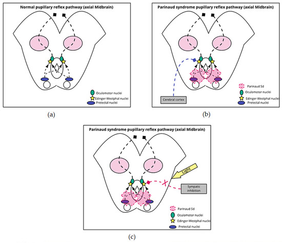 Understanding Parinaud’s Syndrome