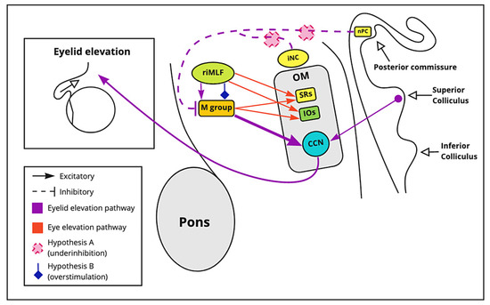Understanding Parinaud’s Syndrome