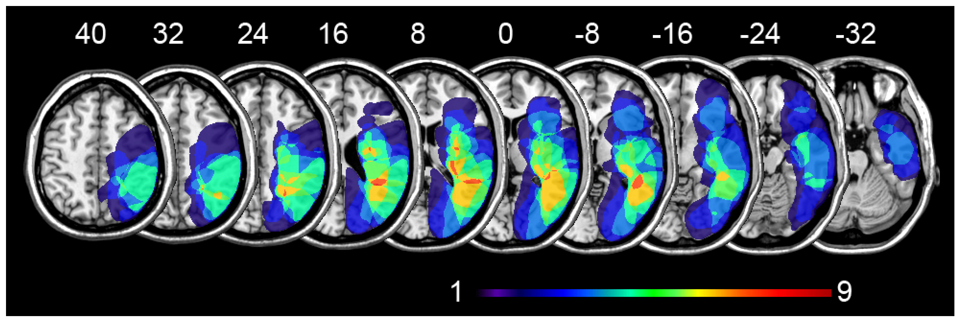 Prism Adaptation and Optokinetic Stimulation Comparison in the ...