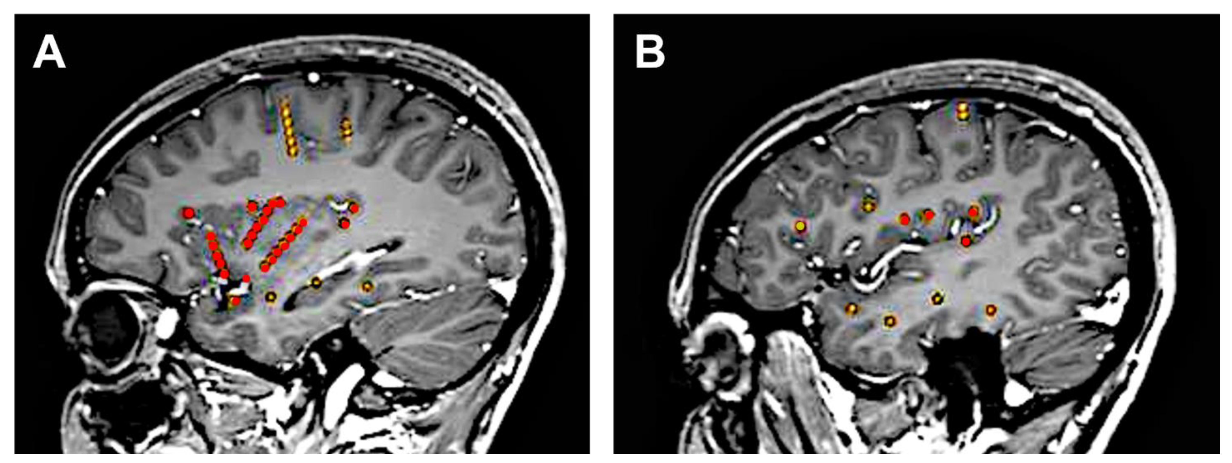 The Insula: A Stimulating Island of the Brain